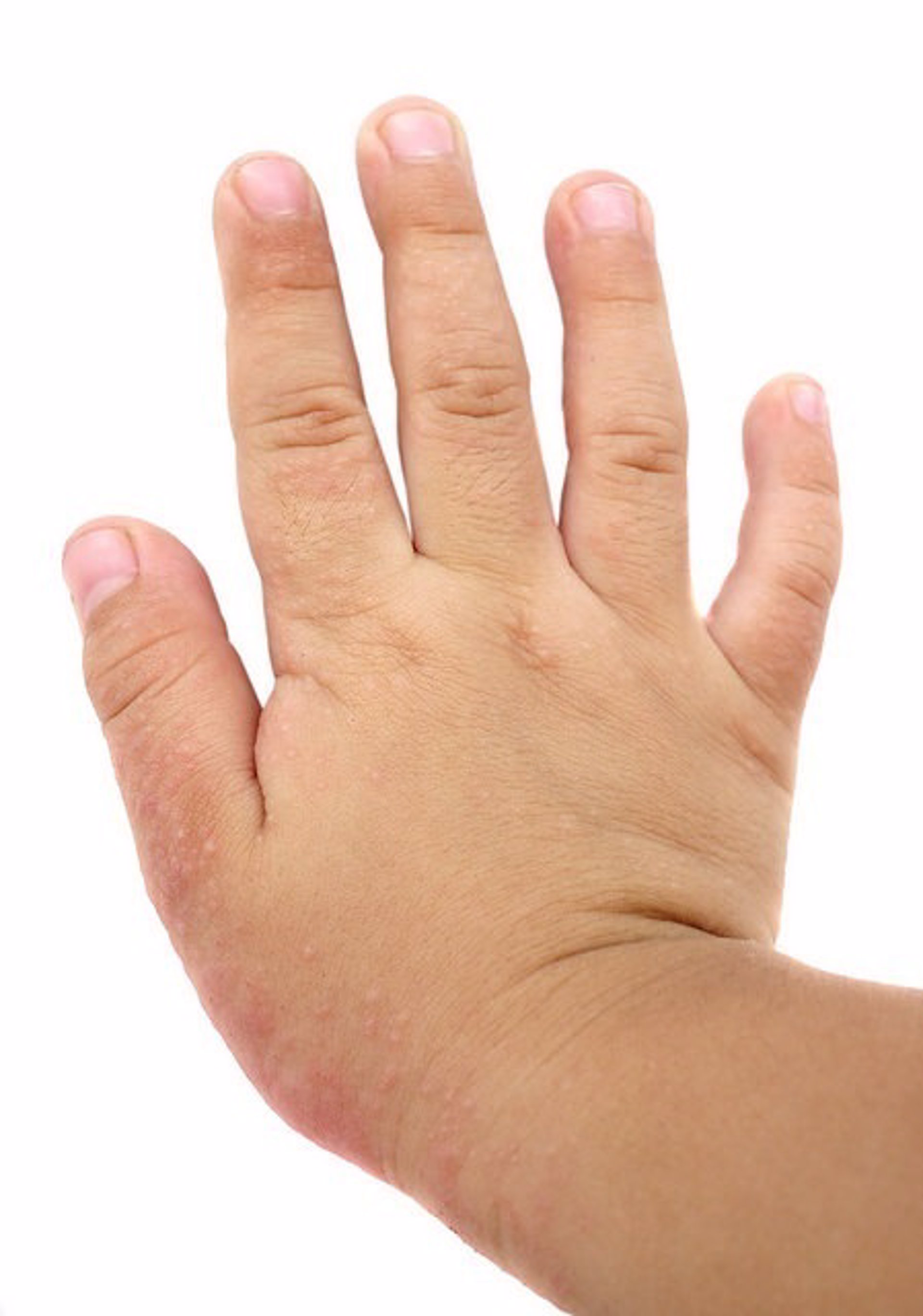 La dermatitis atópica en niños empeora durante el invierno